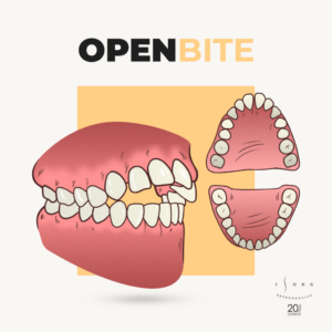 Why Treating and Fixing an Open Bite Is Important - I Song Orthodontic