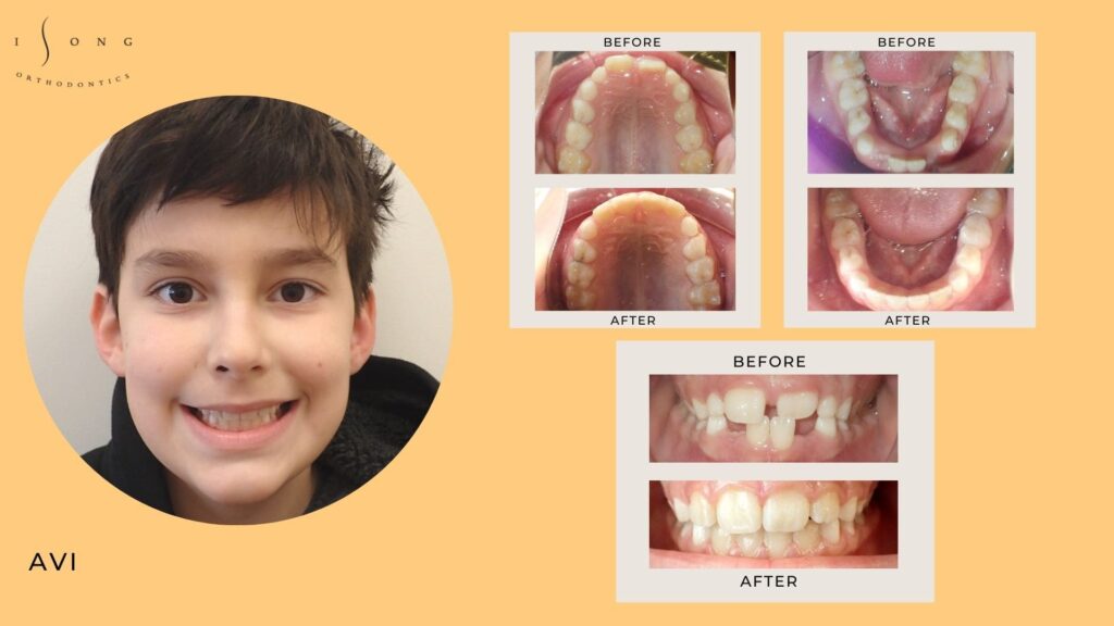 Before & After - Phase I - I Song Orthodontic