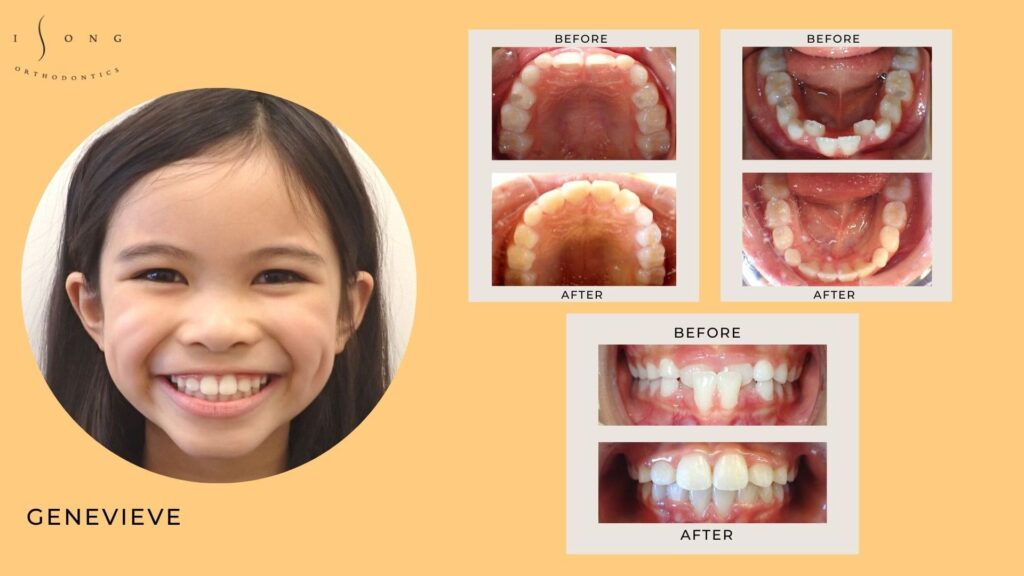 Before & After - Phase I - I Song Orthodontic